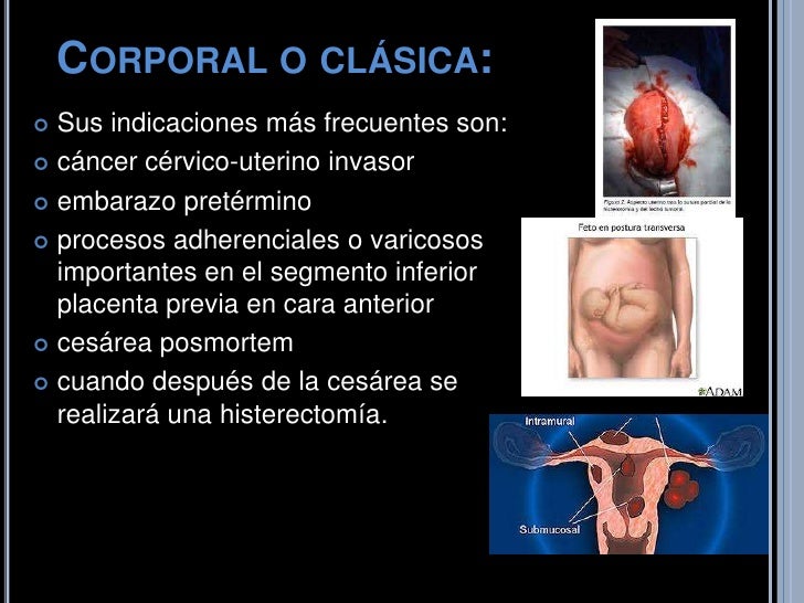 Cesara y tipos de cesareas indicaciones y contraindicaciones