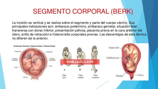 Cesarea