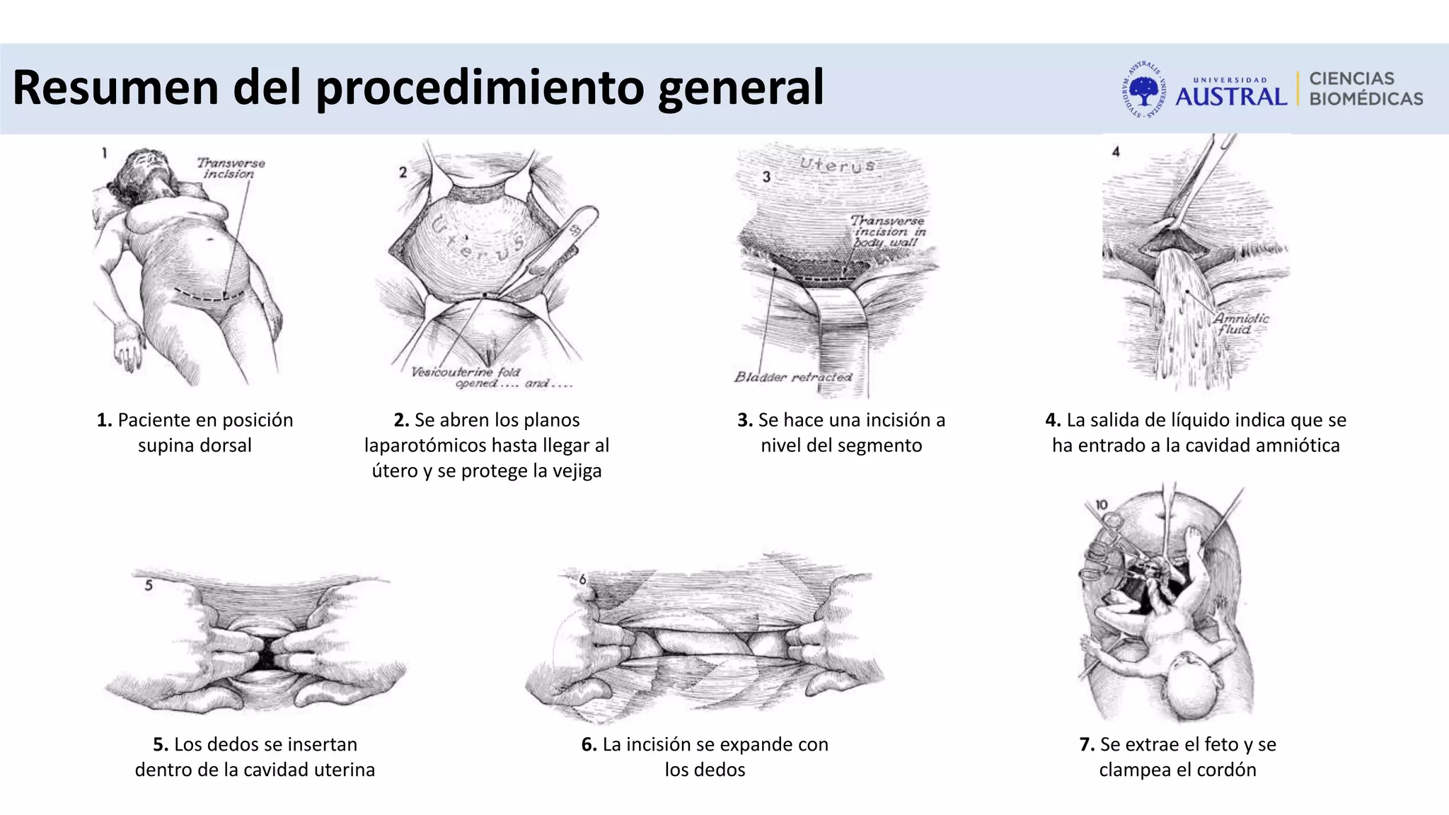 Cesarea Abdominal | PPTX