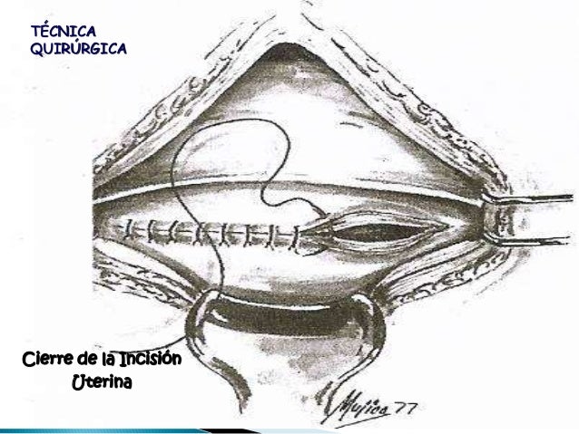 Cesarea