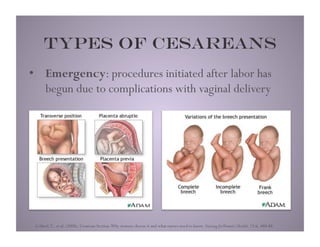 Babies On Demand: Cesarean Delivery by Maternal Request | PDF