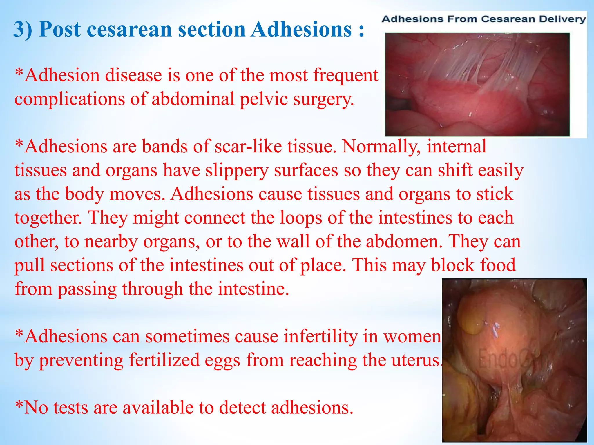 Cesarean section | PDF
