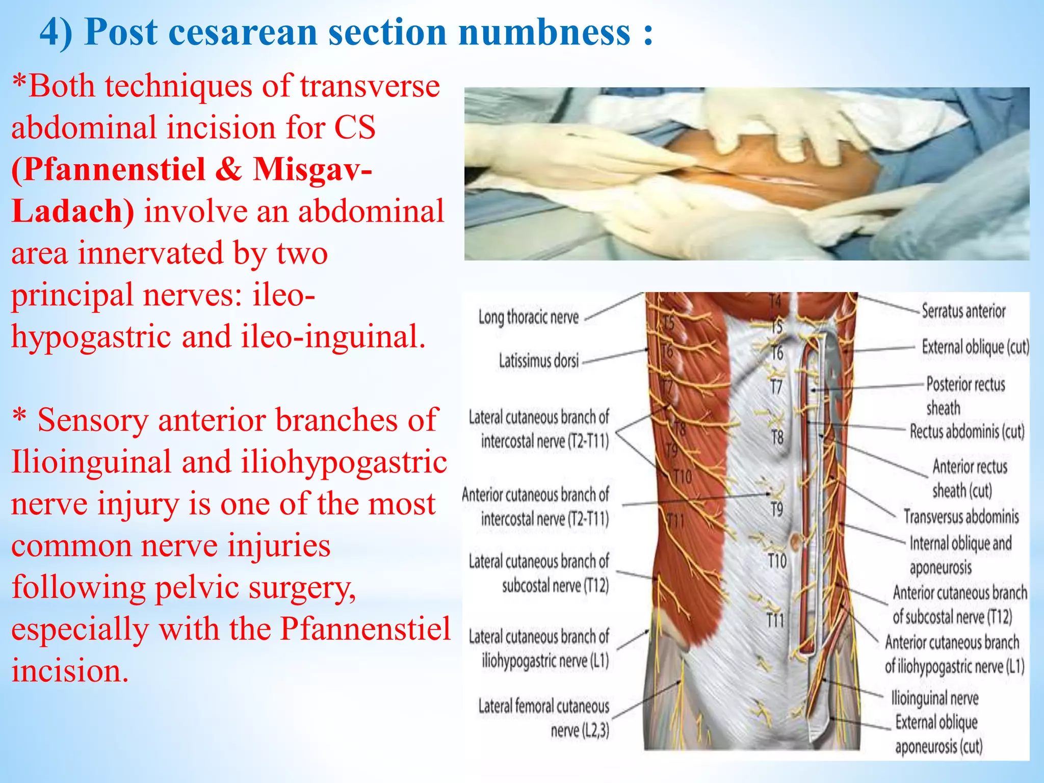 Cesarean section | PDF