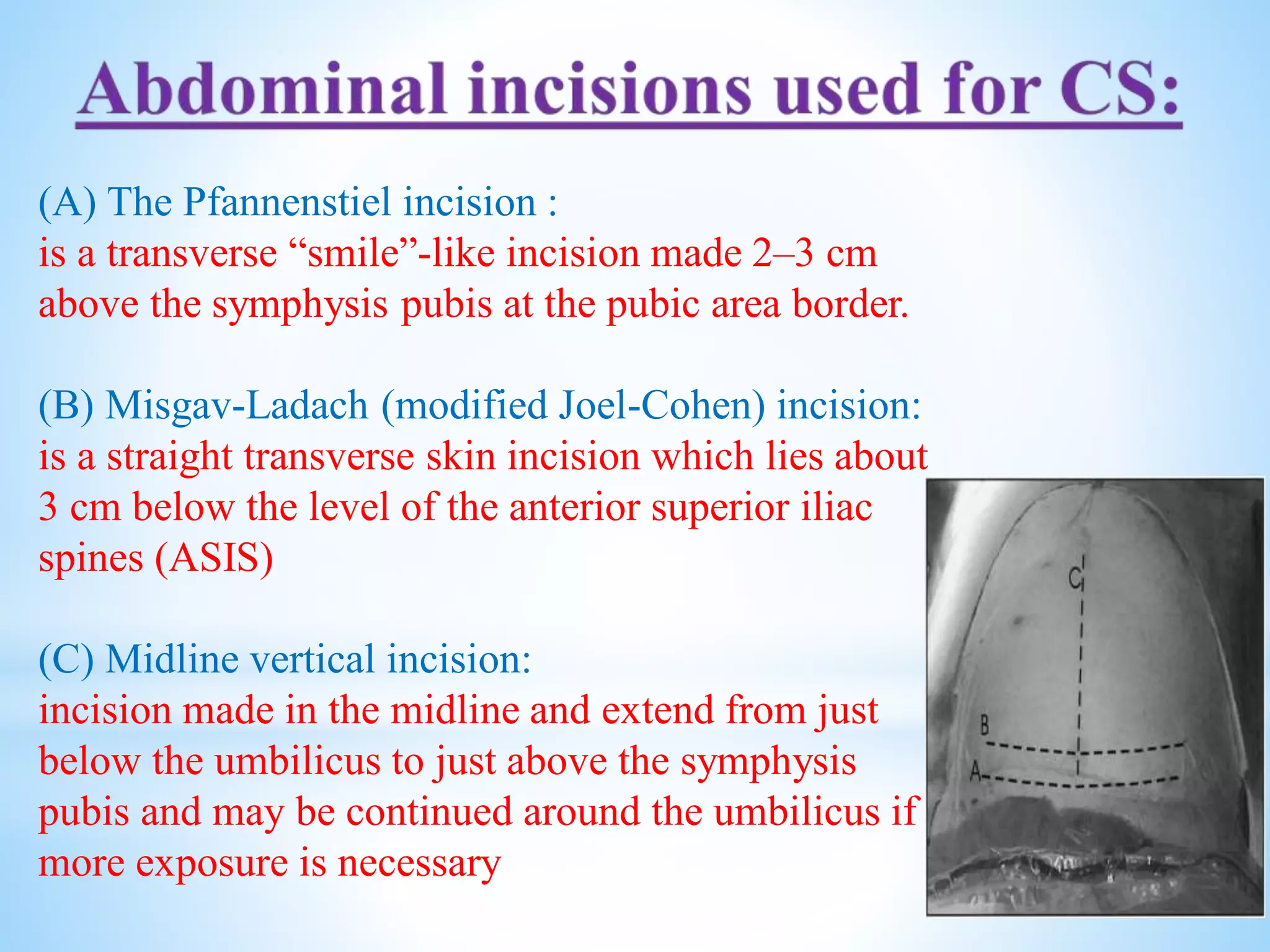 Cesarean section | PDF
