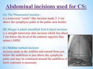 Cesarean section | PDF