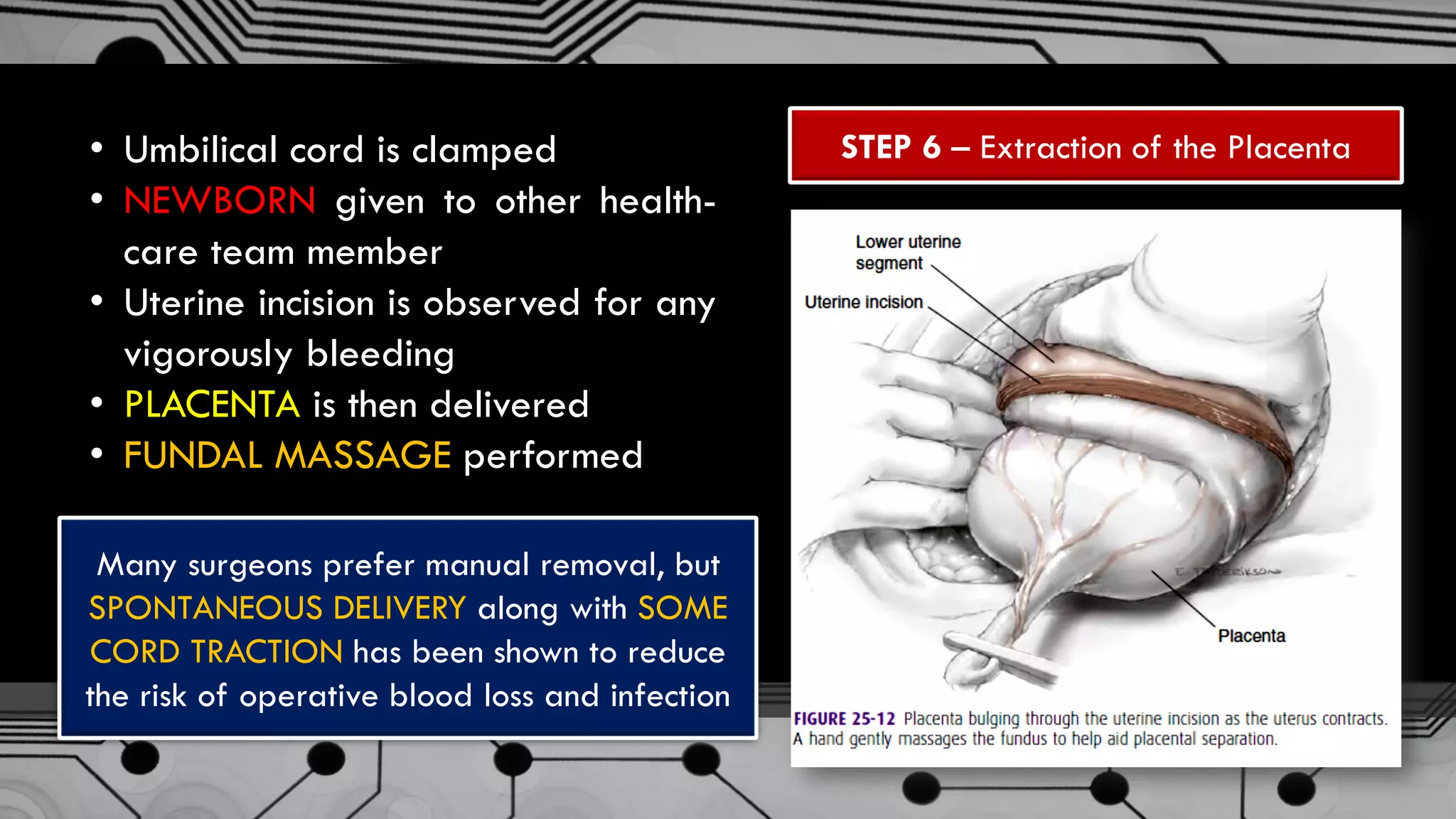 Cesarean Delivery | PDF