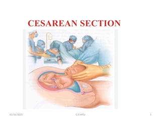 cesarean delivery for midwifery students .pptx
