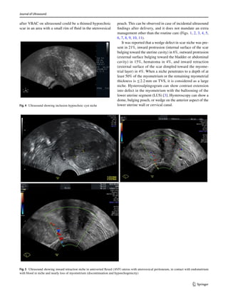 Cesarean scar defects | PDF | Pregnancy | Reproductive Health