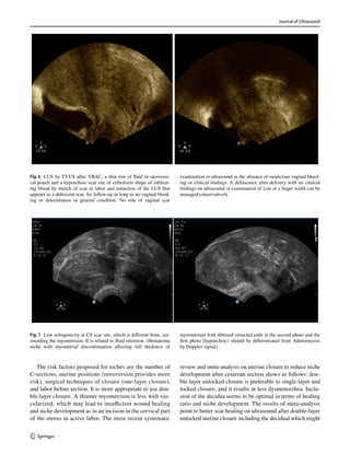 Cesarean scar defects | PDF | Pregnancy | Reproductive Health