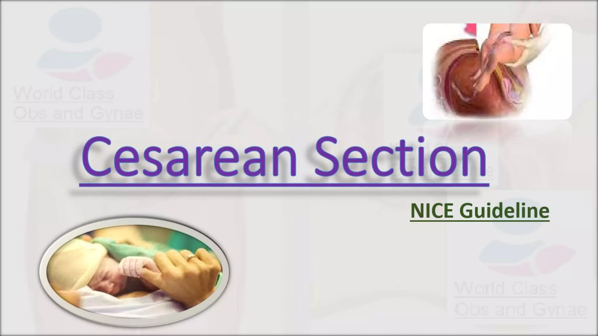 Cesarean section, NICE Guideline 2021 explained on PPT | PPTX