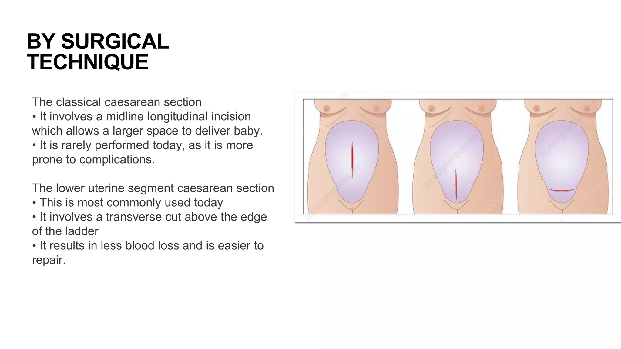 cesarean section.pptx