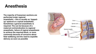 cesarean section.pptx