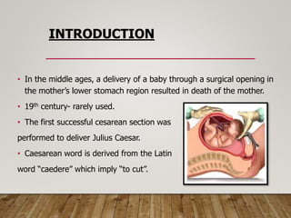 CESAREAN SECTION.pptx