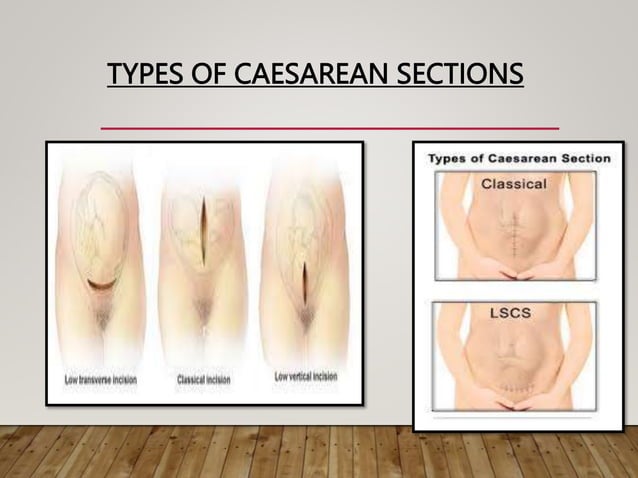 CESAREAN SECTION.pptx
