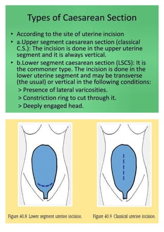 Cesarean section over Labor: indications and advantages | PPTX