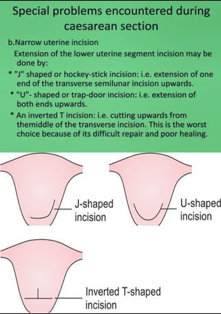 Cesarean section over Labor: indications and advantages | PPTX