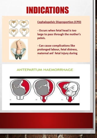 Cesarean section over Labor: indications and advantages | PPTX