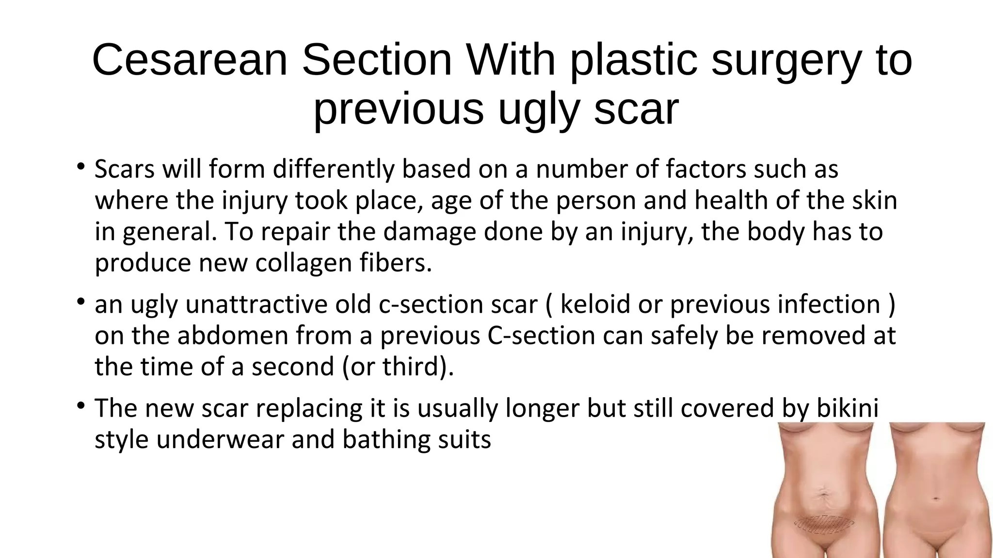 Cesarean section and associated surgeries from the same incision | PPT