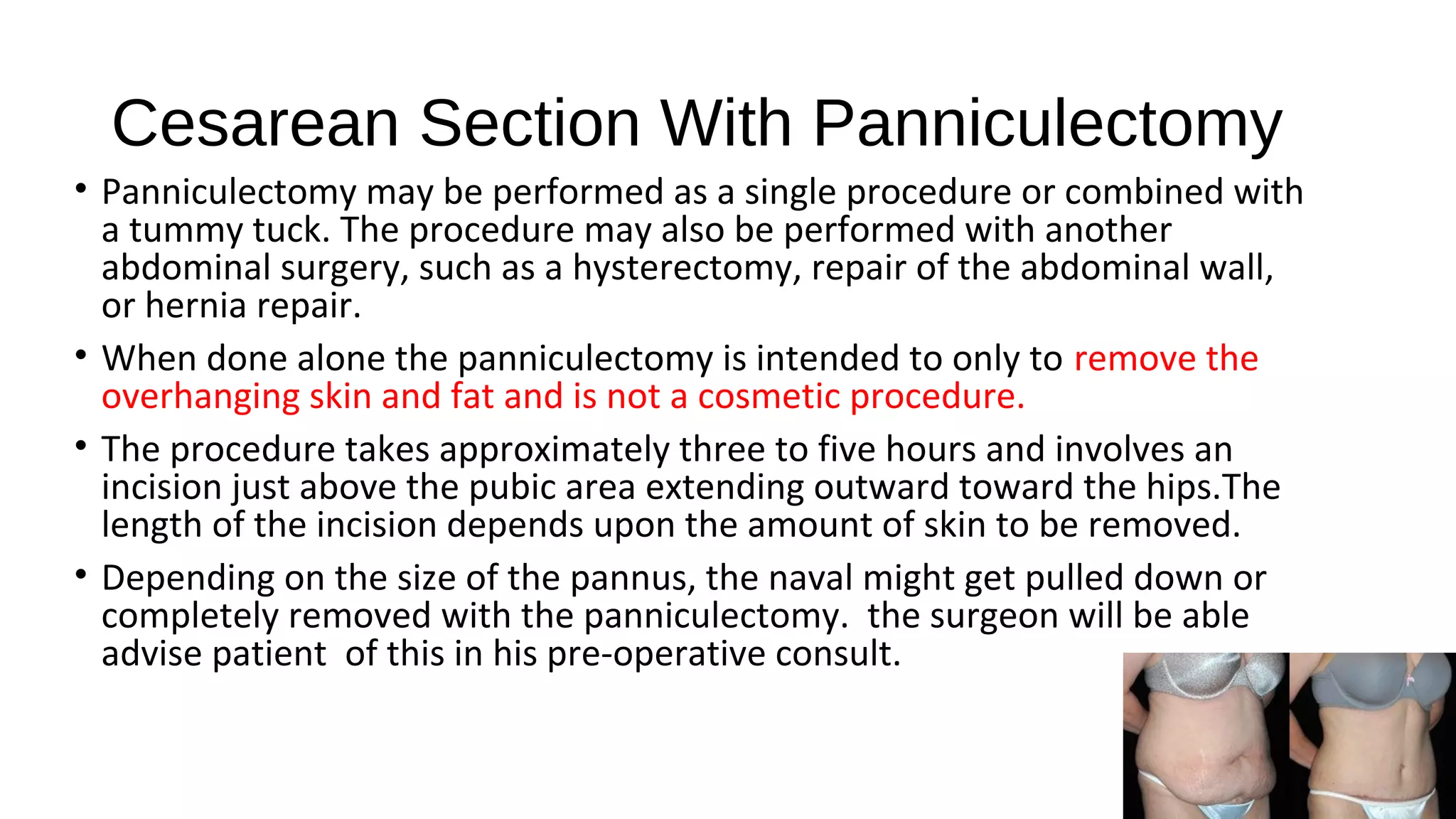 Cesarean section and associated surgeries from the same incision | PPT
