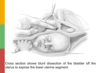 Cesarean section@DrJB | PPTX