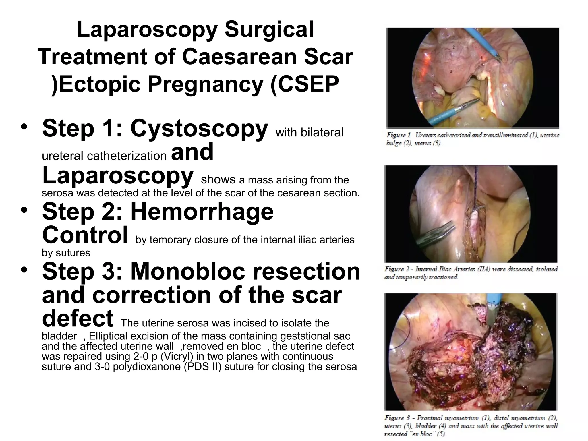 Cesareansectionscardefects Ppt Free Download