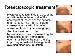 Cesareansectionscardefects | PPT