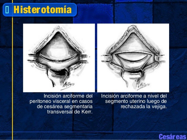 Cesareas huespe final