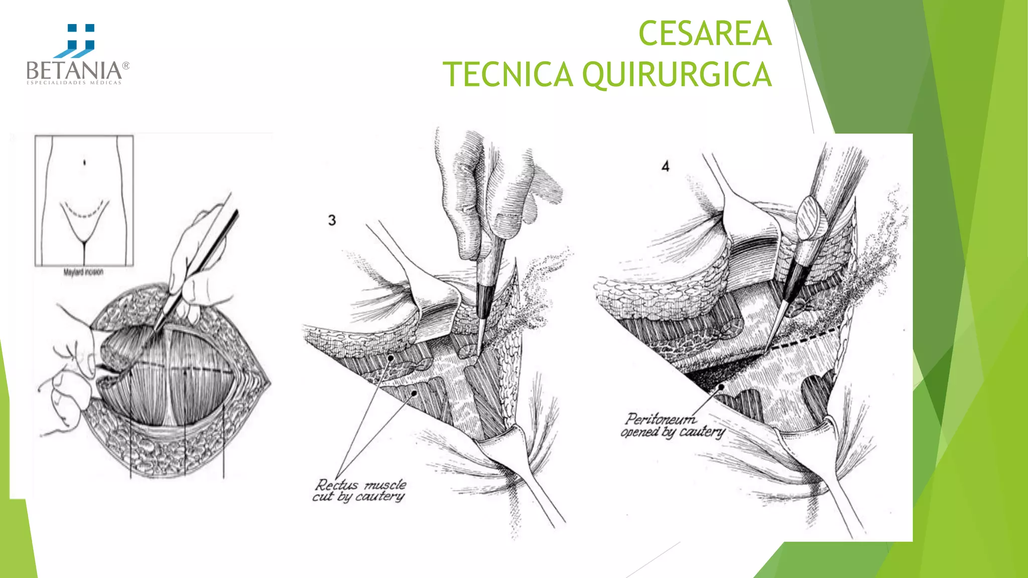 Cesarea tecnica quirurgica | PDF