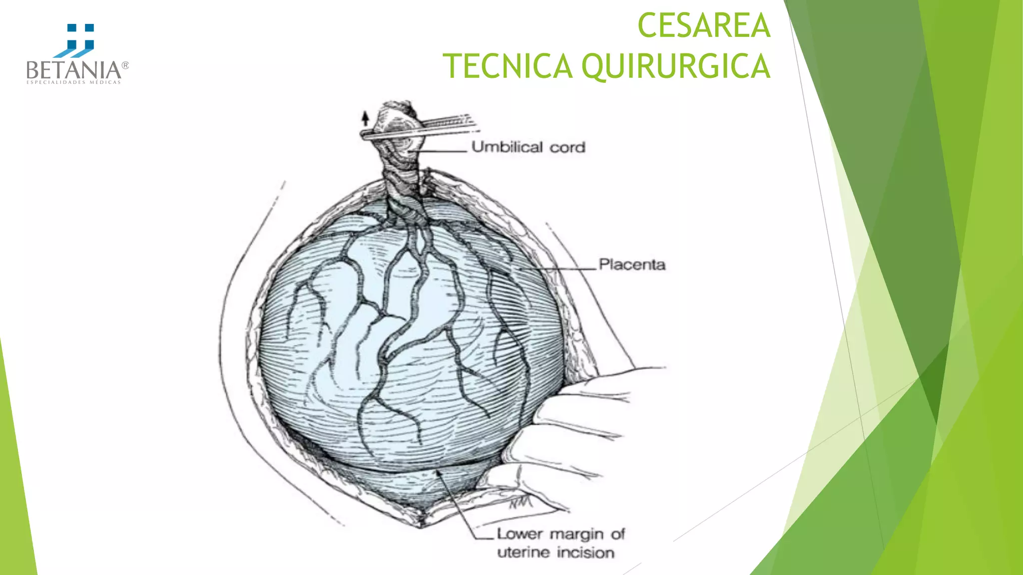 Cesarea tecnica quirurgica | PDF
