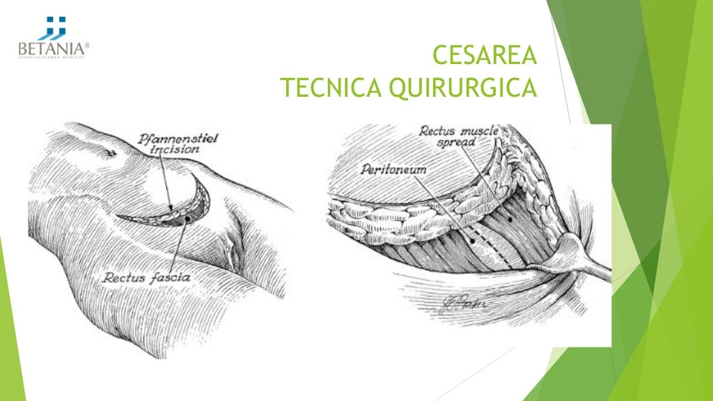 Cesarea tecnica quirurgica