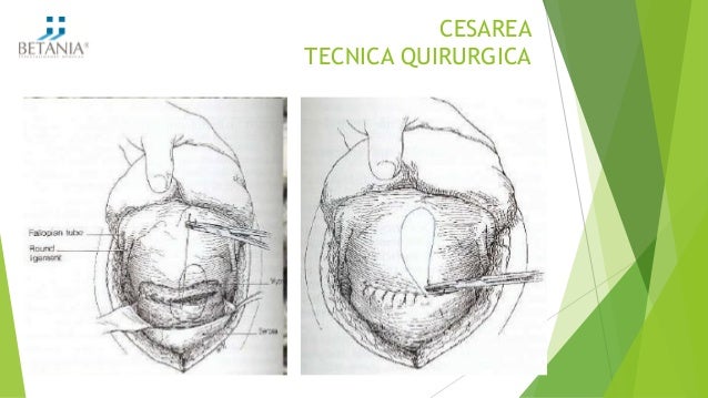 Cesarea tecnica quirurgica