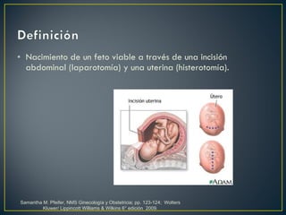 Cesárea, Técnica Quirúrgica. | PPT