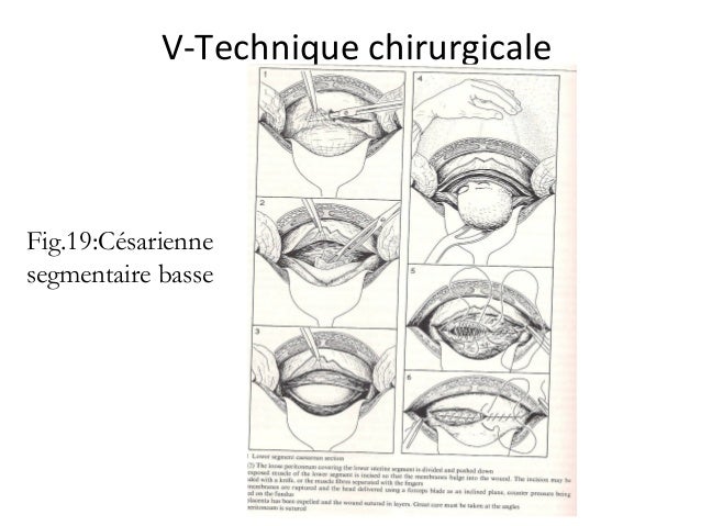 Cesarienne