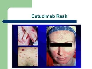 Cetuximab Plus Radiotherapy For Head And Neck Cancer | PPT