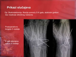 Četvorougaona artrodeza ručja | PPT