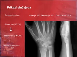 Četvorougaona artrodeza ručja | PPT