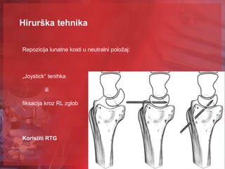Četvorougaona artrodeza ručja | PPT
