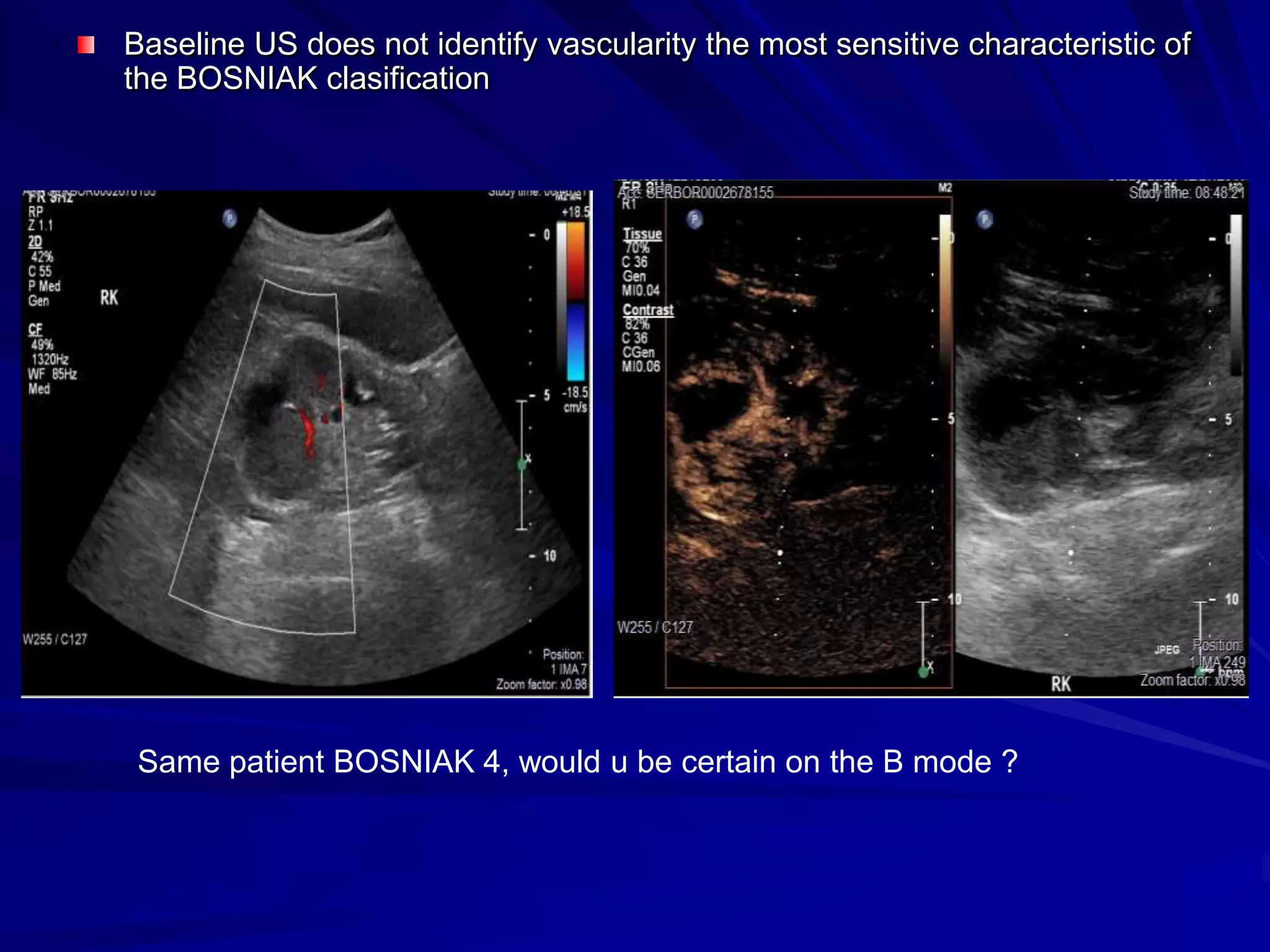 Ceus bosniak classification of renal cysts | PDF