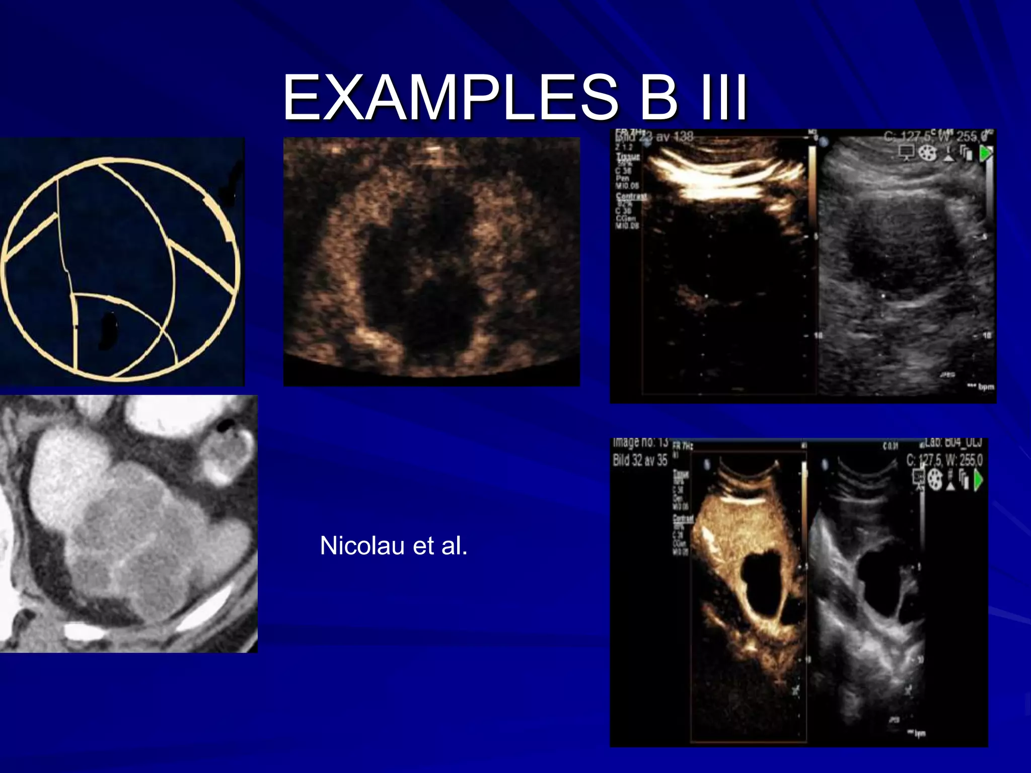 Ceus bosniak classification of renal cysts | PDF