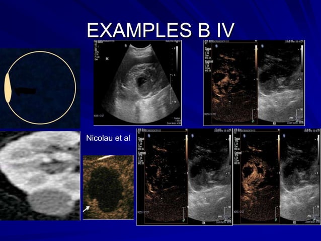 Ceus bosniak classification of renal cysts | PDF