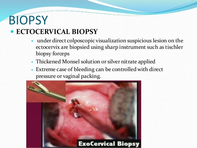 Cevical intraepithelial neoplasia