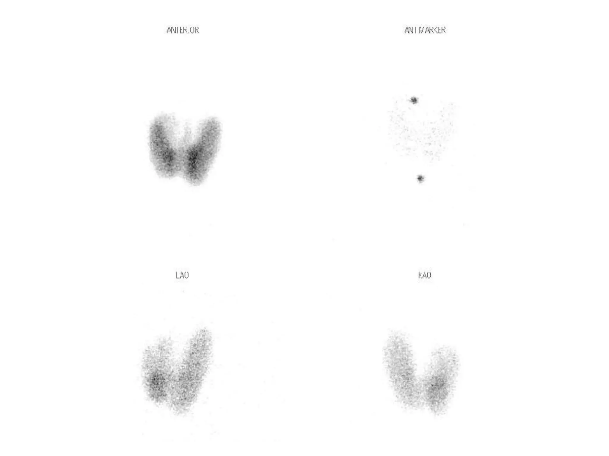 Nuclear medicine thyroid imaging | PPTX
