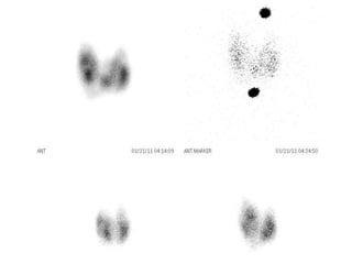 Nuclear medicine thyroid imaging | PPTX