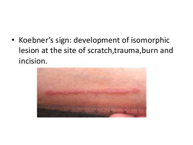 PSORIASIS