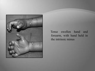 3 A’S Of Pediatric Compartment syndrome | PPTX