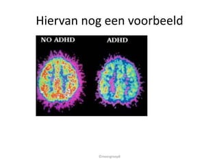 ADHD uitgelegd | PPT