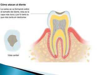 C:\fakepath\caries | PPT