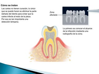 C:\fakepath\caries | PPT