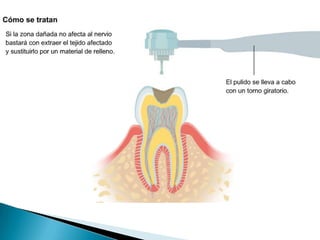 C:\fakepath\caries | PPT