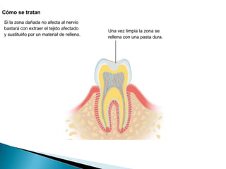 C:\fakepath\caries | PPT